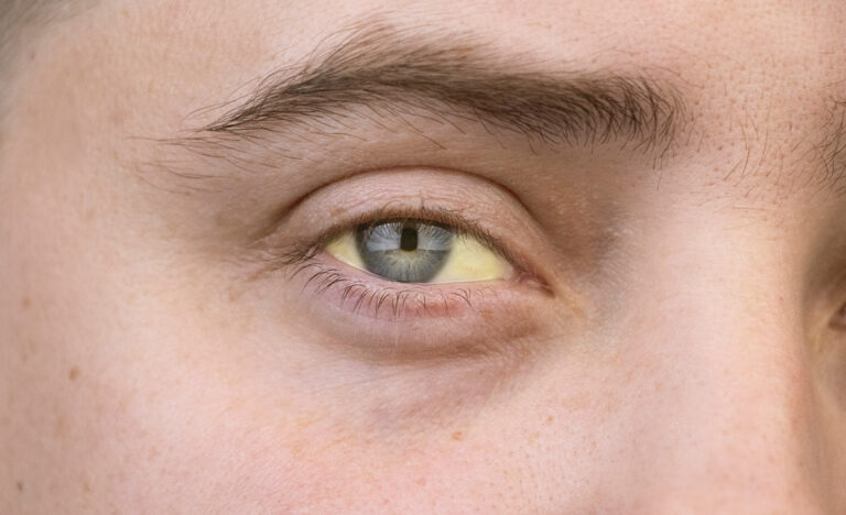 Discolored Eyes - EYE-Q Vision Care