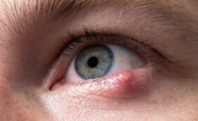 Basal Cell Carcinoma - EYE-Q Vision Care