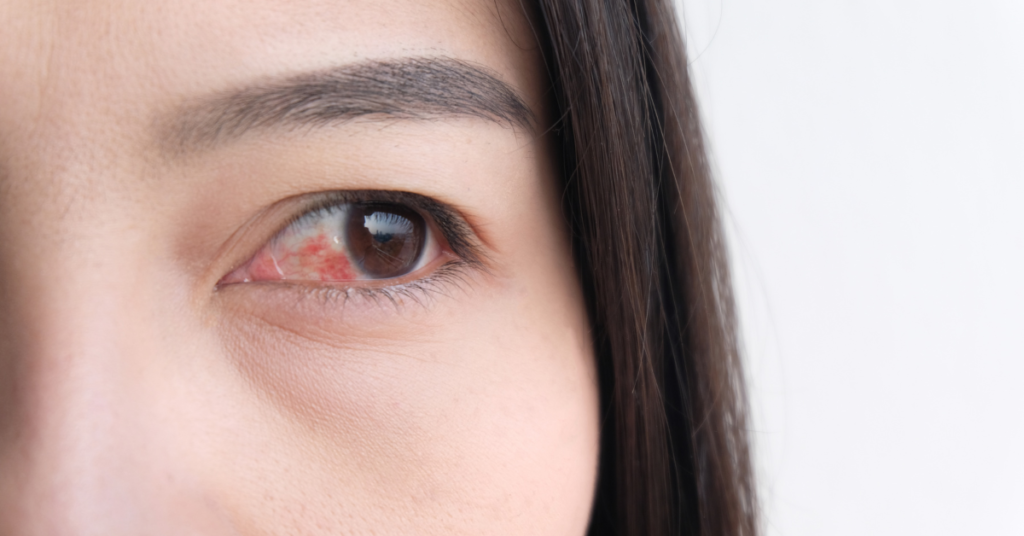 All you need to know about conjunctivitis - EYE-Q Vision Care